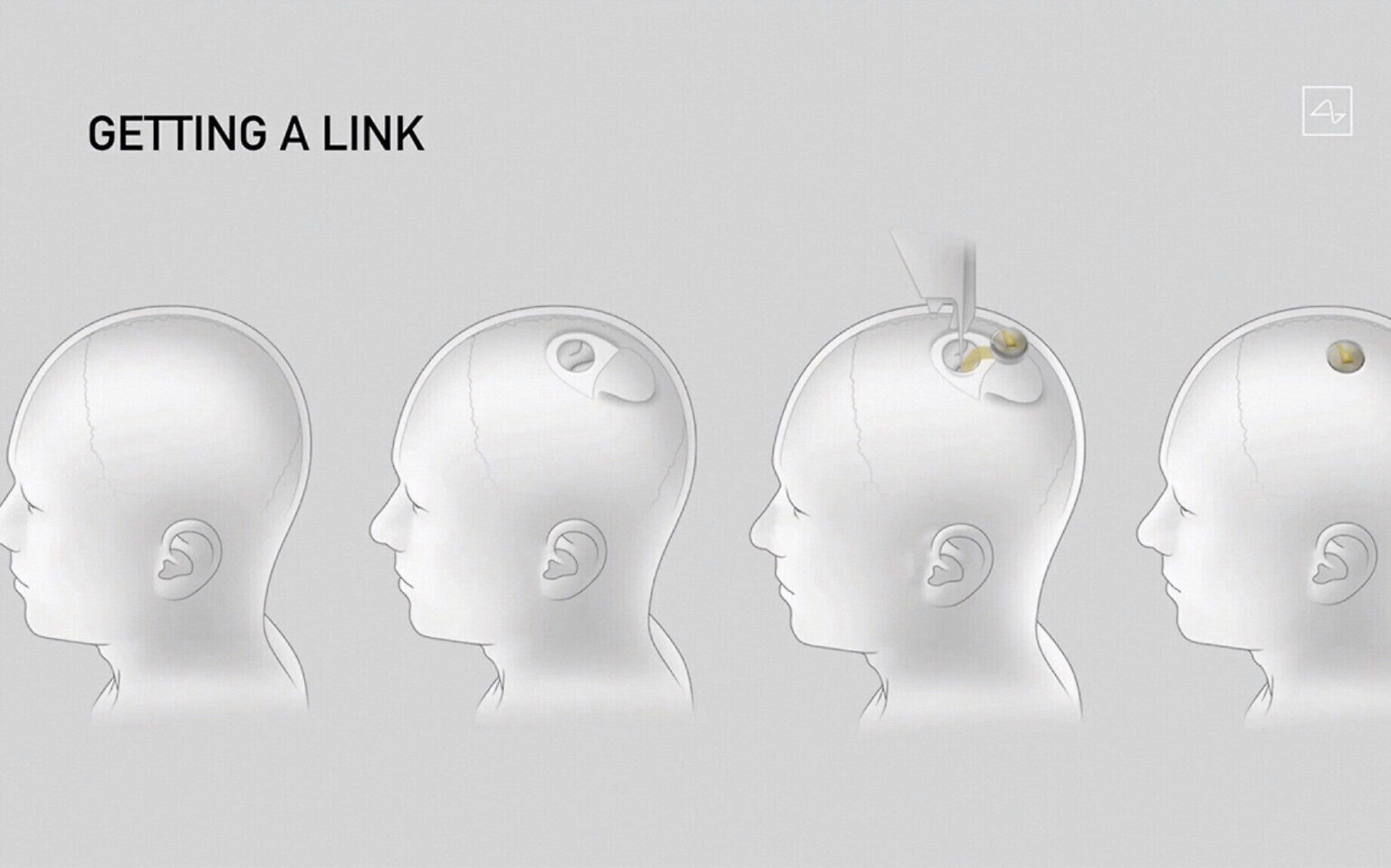 Neuralink has Begun Human Trials Despite Warnings to Elon Musk - Gadget ...