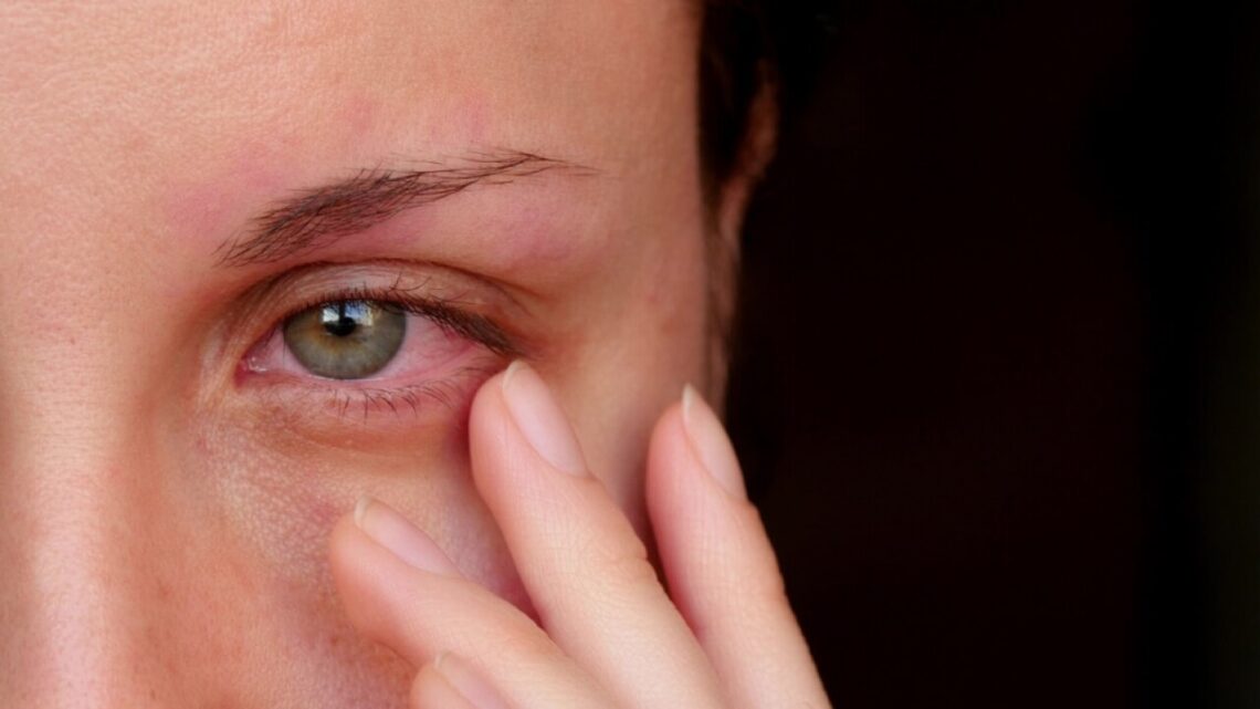 How Does Eye Syphilis Occur? Doctors Are Seeing Severe Symptoms Due to ...